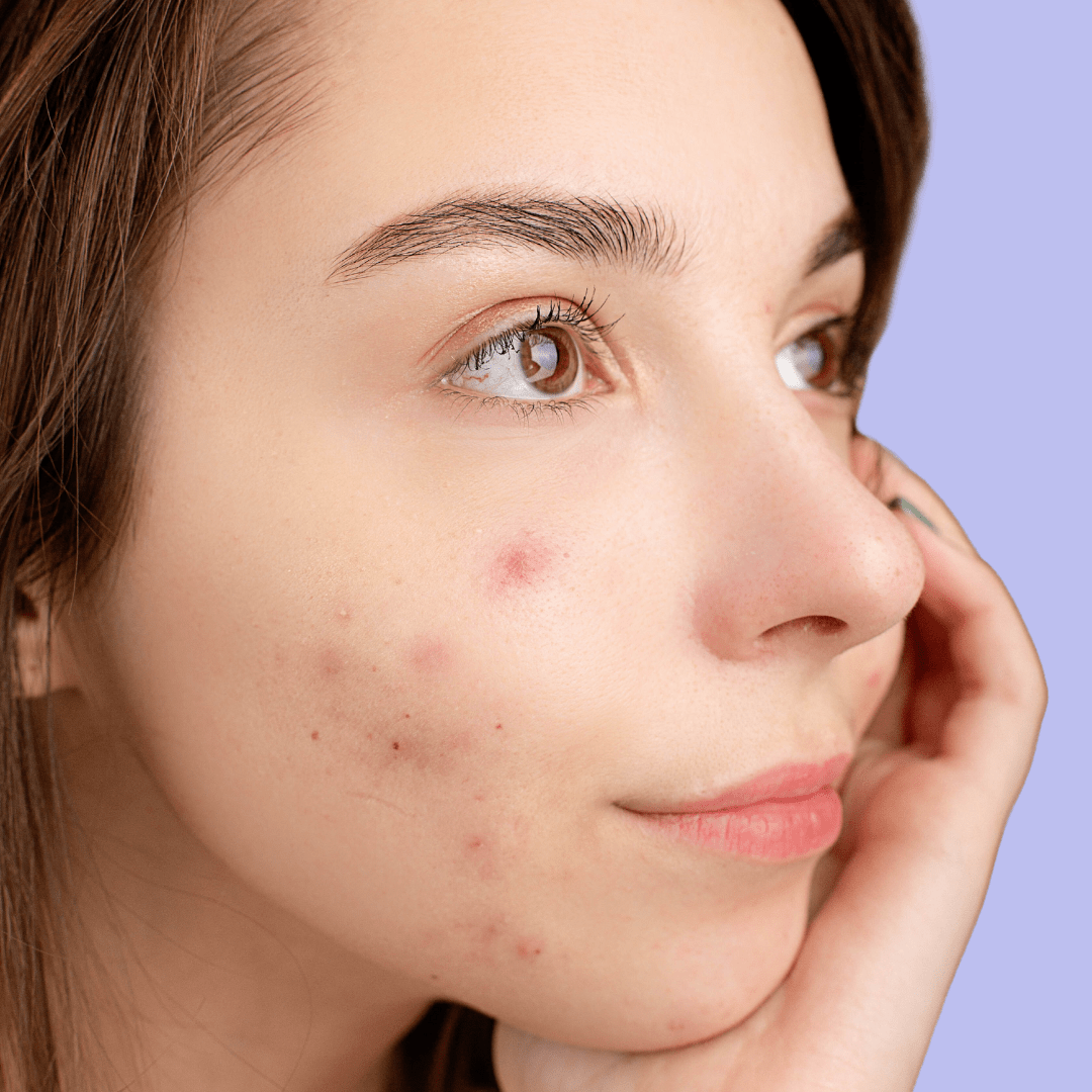 Clear Skin Guide: Solutions for Acne, Breakouts and Blackheads ...